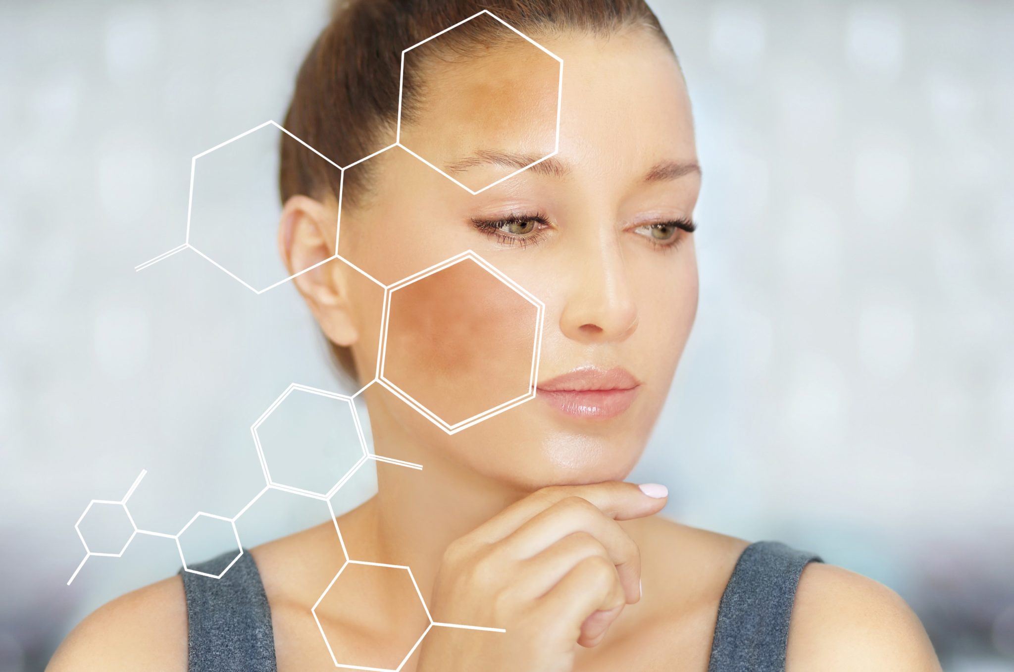 Melasma (Hyperpigmentierung) mit LaseMD behandeln